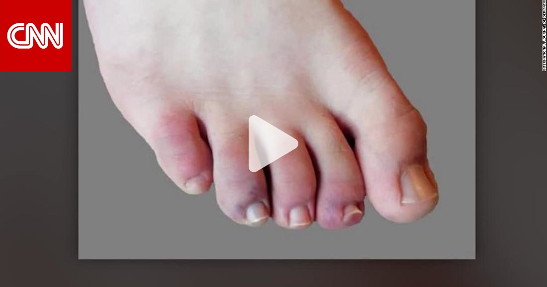 إليكم عارضا جديدا قد يدل على الإصابة بفيروس كورونا - CNN Arabic