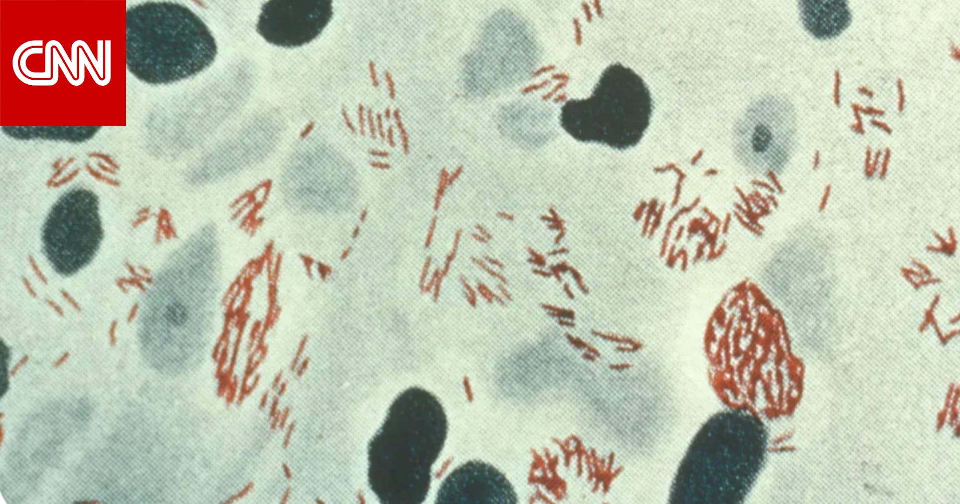 The Rising Cases of Leprosy in Central Florida: Causes, Symptoms, and ...