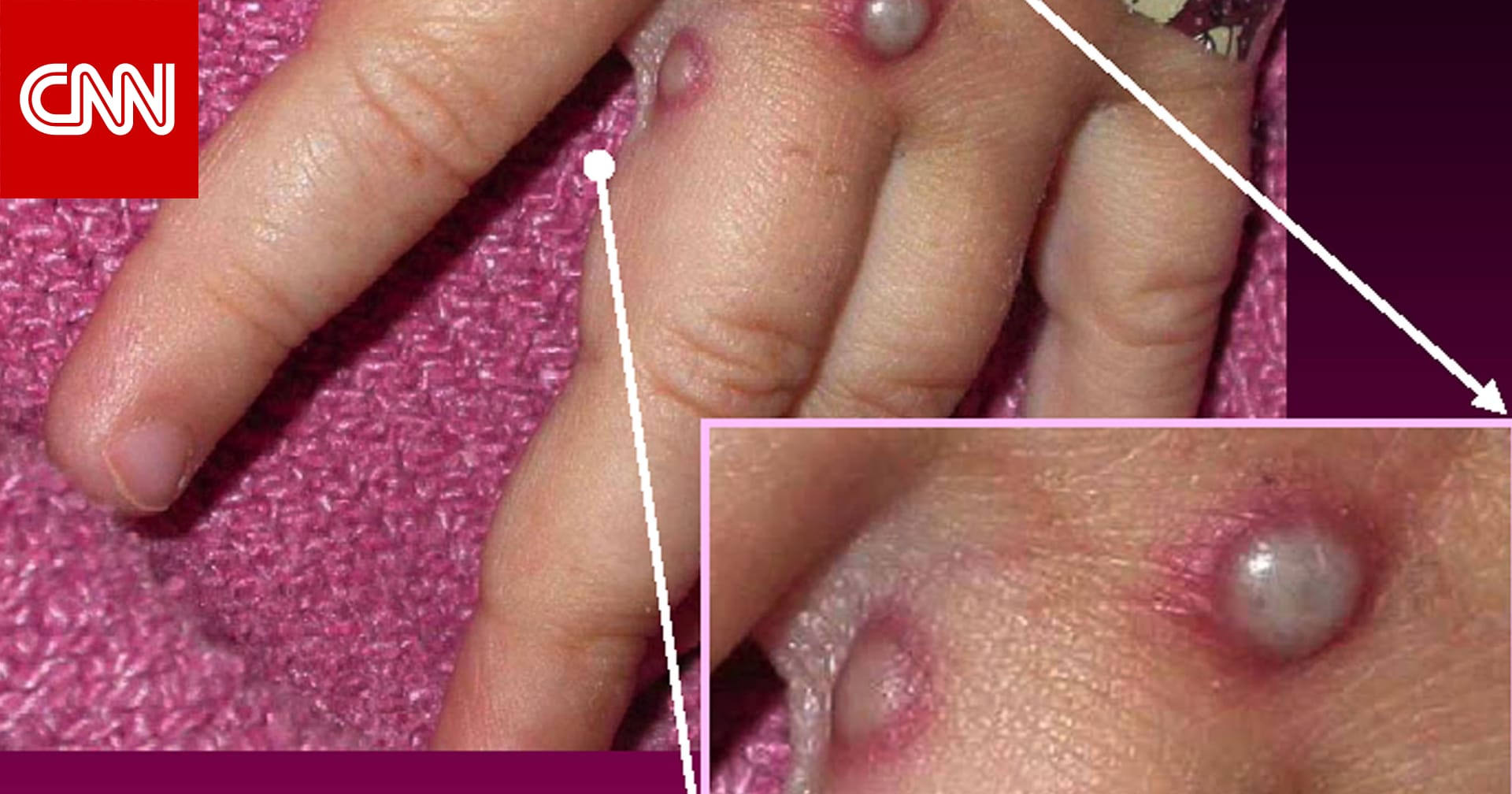 جدري القردة.. اجتماع طارئ لـWHO يكشف عدد الحالات المشتبه بها بأوروبا - CNN Arabic